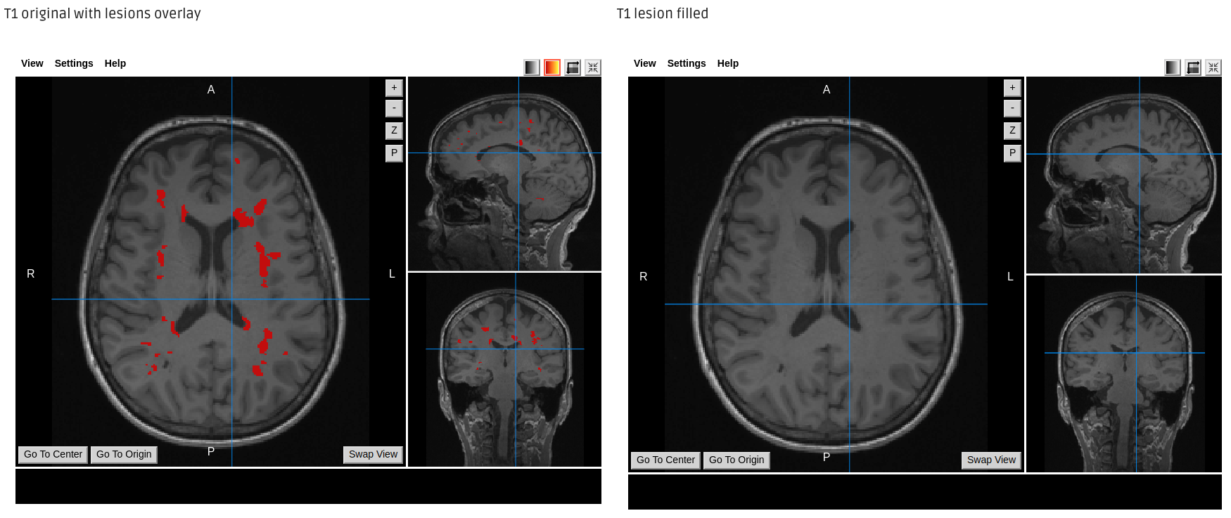 Lesion Segmentation Workflow